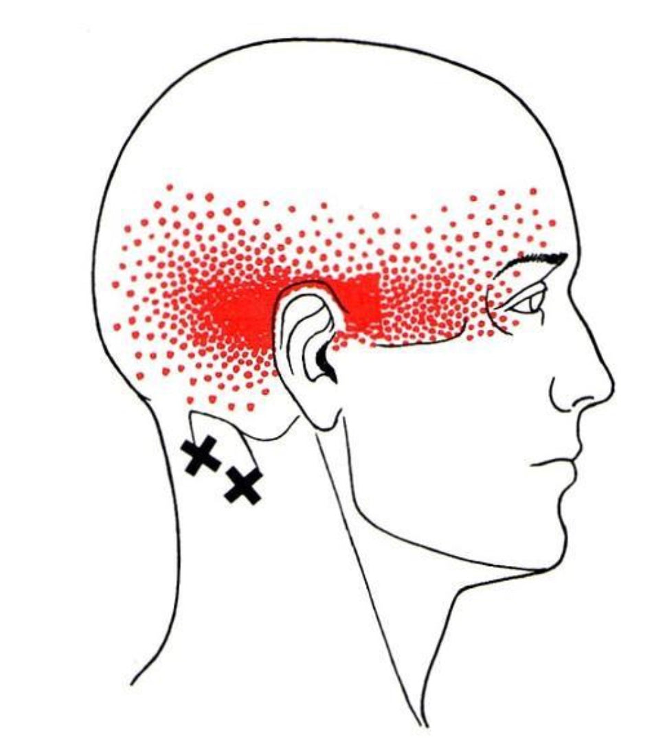 Migraines Vs. Cervicogenic headaches: Unravelling the differences ...